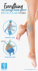 Everything You Should Know About Reticular Veins - VeinCare
